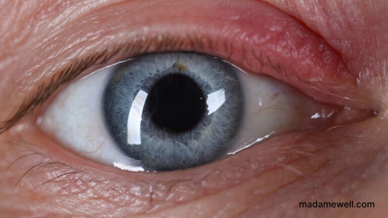 Seborrheic Dermatitis Of The Eyelids: What Can You Do About It?