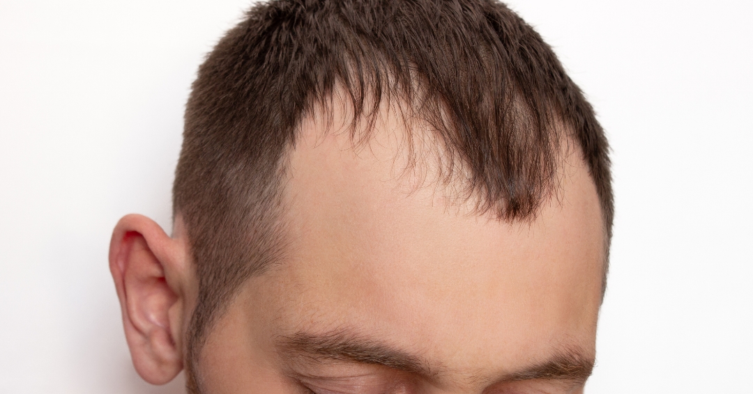 How To Treat Seborrheic Dermatitis Of The Hairline